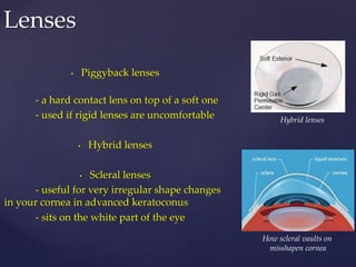 Keratoconus presentation | PPT