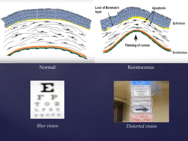 Keratoconus presentation | PPT
