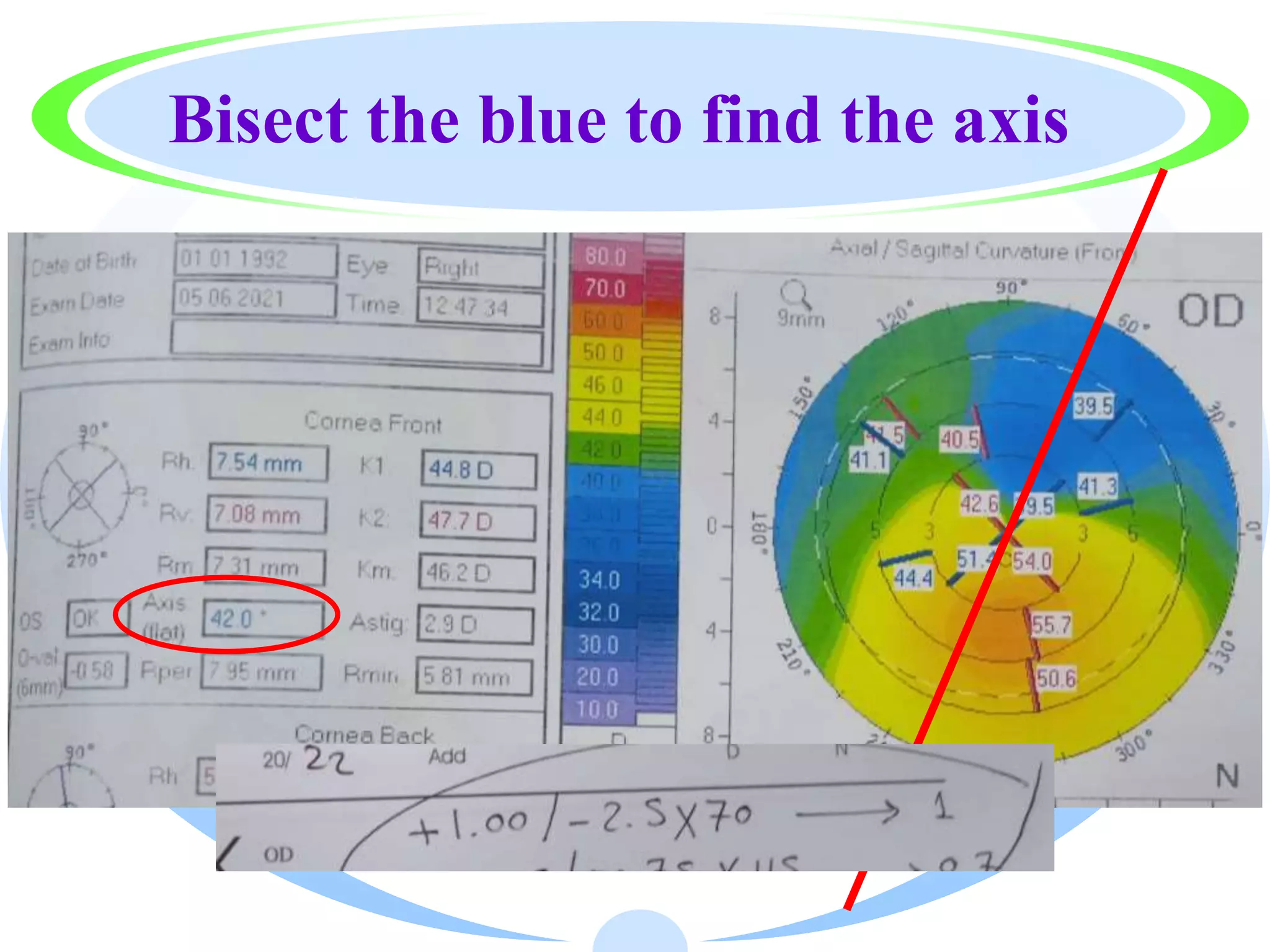 Keratoconus refraction | PPT