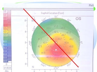 Keratoconus refraction | PPTX