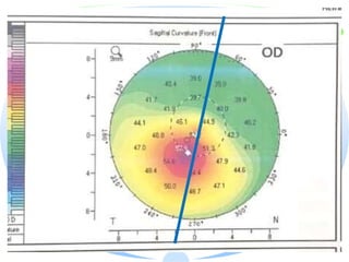 Keratoconus refraction | PPTX