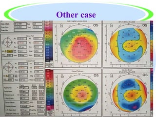 Keratoconus refraction | PPTX