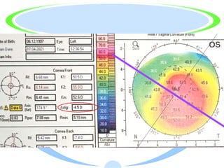 Keratoconus refraction | PPTX