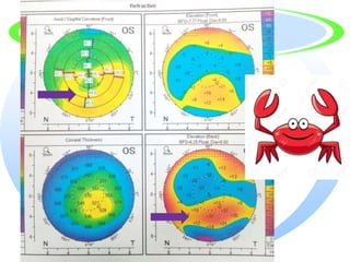 Keratoconus refraction | PPTX