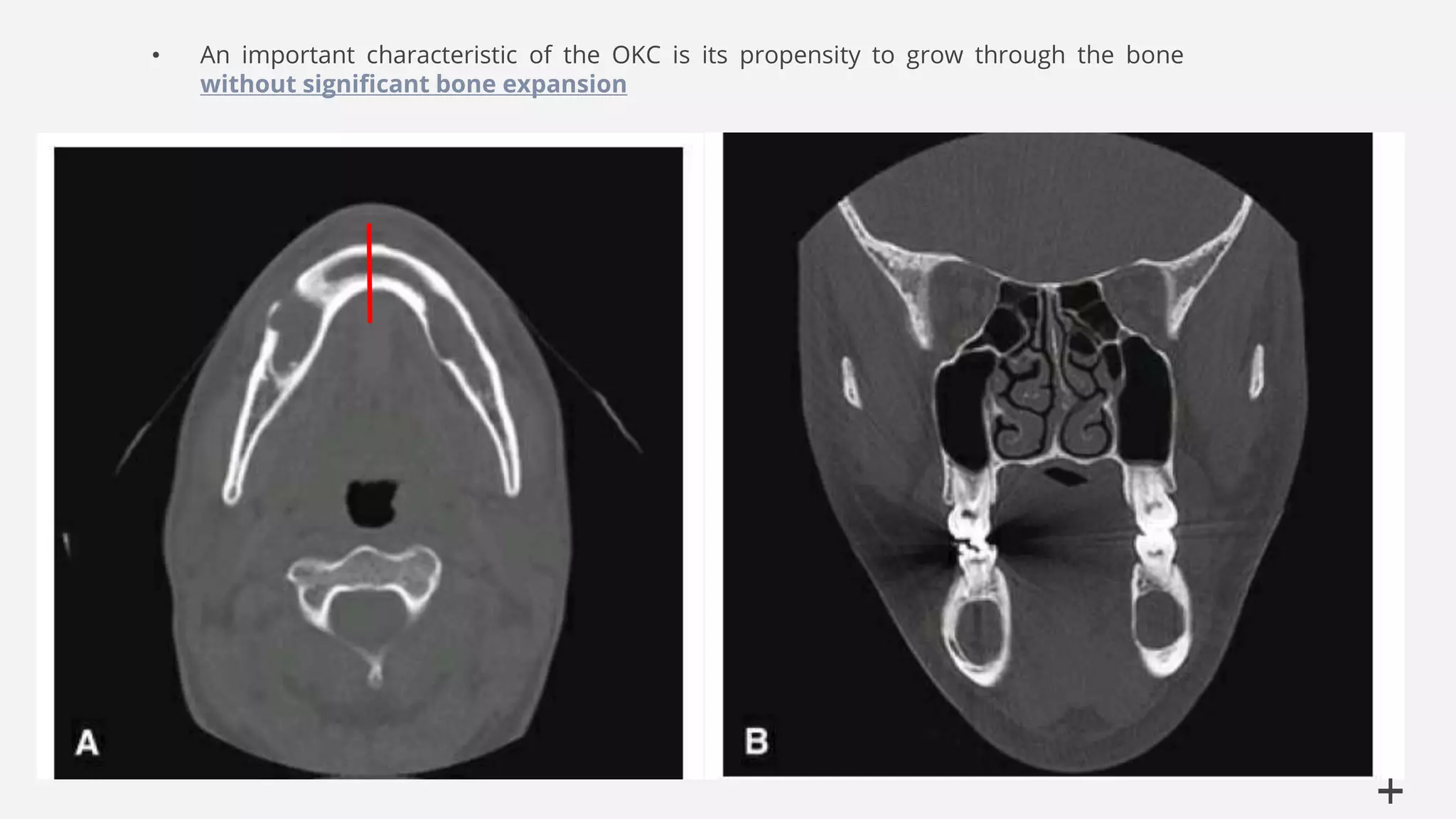 Keratocystic odontogenic tumors(KCOT) or Odontogenic Keratocyst(OKC)OKC ...