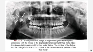 Keratocystic odontogenic tumors(KCOT) or Odontogenic Keratocyst(OKC)OKC ...