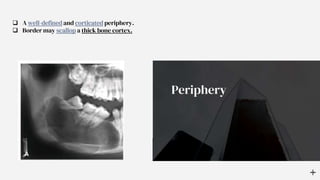 Keratocystic odontogenic tumors(KCOT) or Odontogenic Keratocyst(OKC)OKC ...