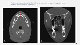 Keratocystic odontogenic tumors(KCOT) or Odontogenic Keratocyst(OKC)OKC ...