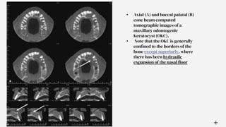 Keratocystic odontogenic tumors(KCOT) or Odontogenic Keratocyst(OKC)OKC ...
