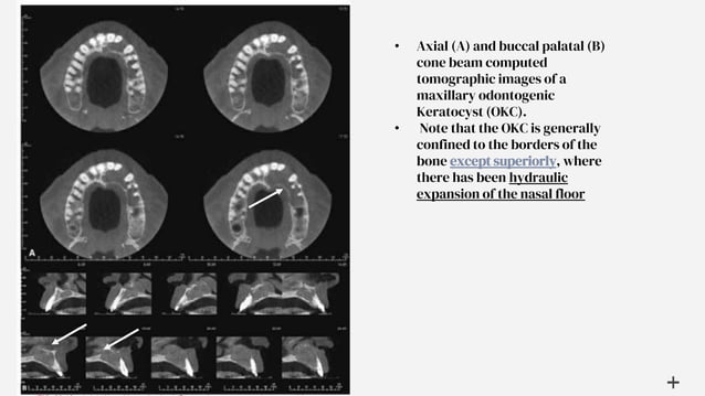 Keratocystic odontogenic tumors(KCOT) or Odontogenic Keratocyst(OKC)OKC ...
