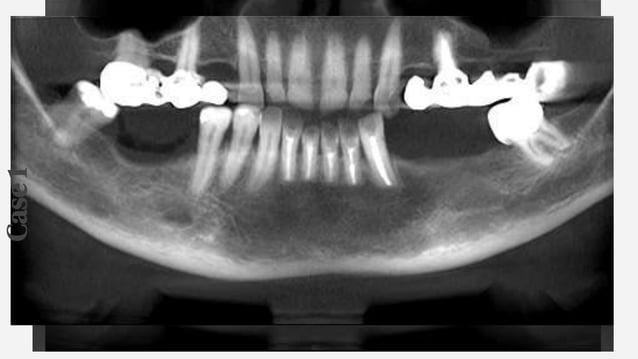 Keratocystic odontogenic tumors(KCOT) or Odontogenic Keratocyst(OKC)OKC ...