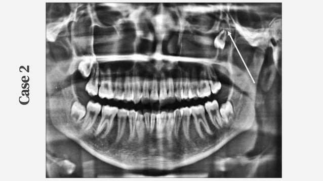 Keratocystic odontogenic tumors(KCOT) or Odontogenic Keratocyst(OKC)OKC ...