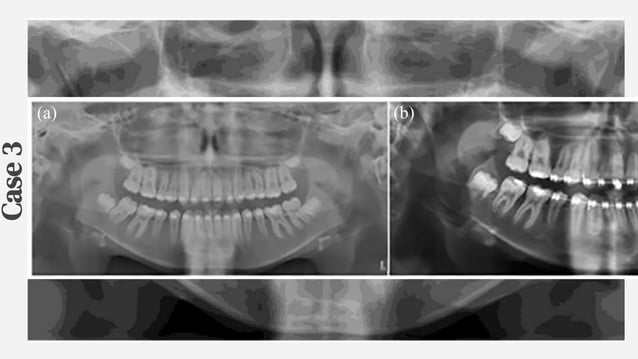 Keratocystic odontogenic tumors(KCOT) or Odontogenic Keratocyst(OKC)OKC ...