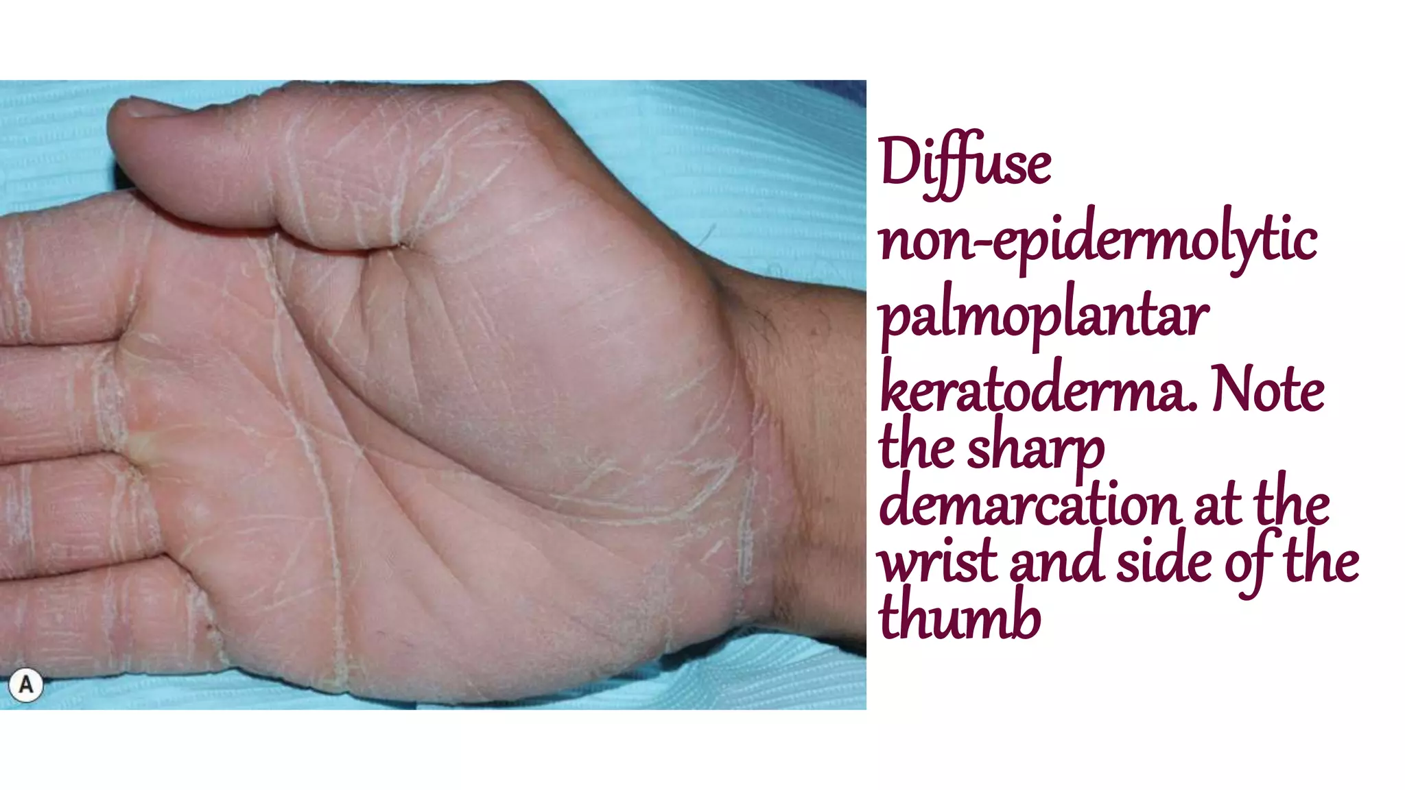 Palmoplantar Keratodermas | PPTX