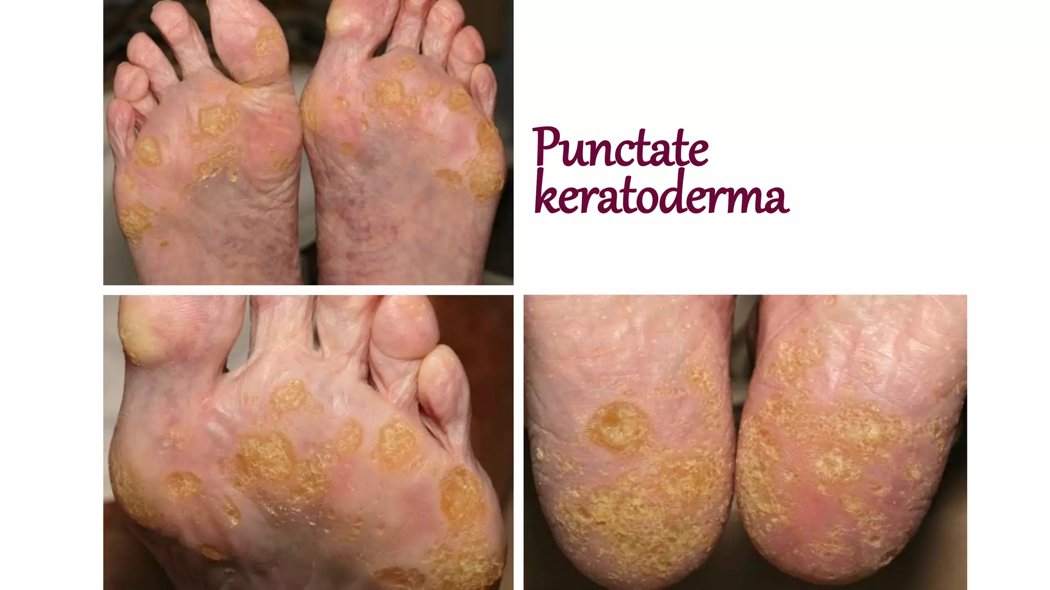 Palmoplantar Keratodermas | PPTX
