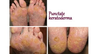 Punctate Keratosis