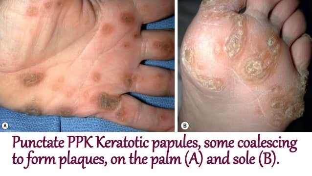 Palmoplantar Keratodermas