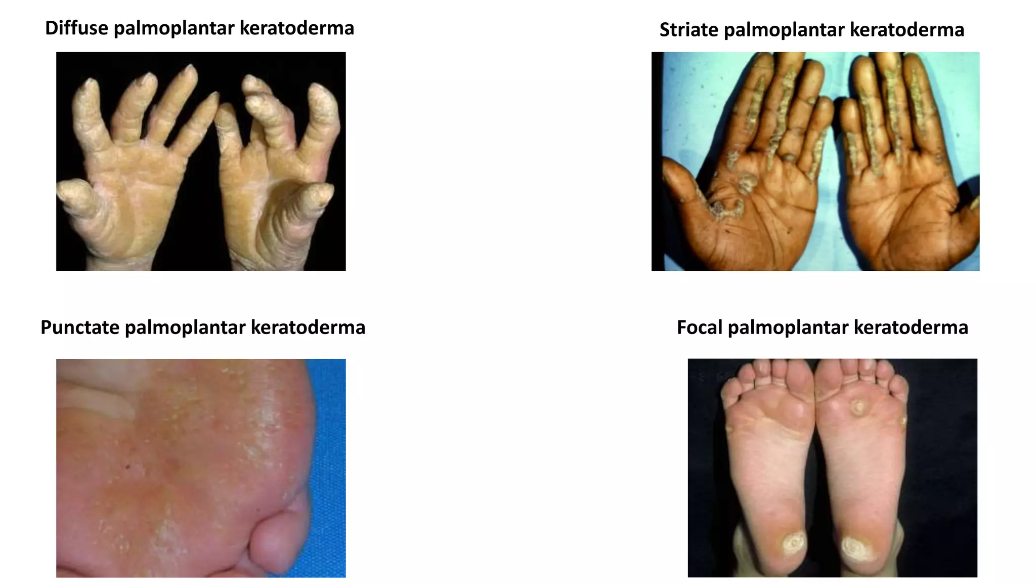 Keratodermas | PPT