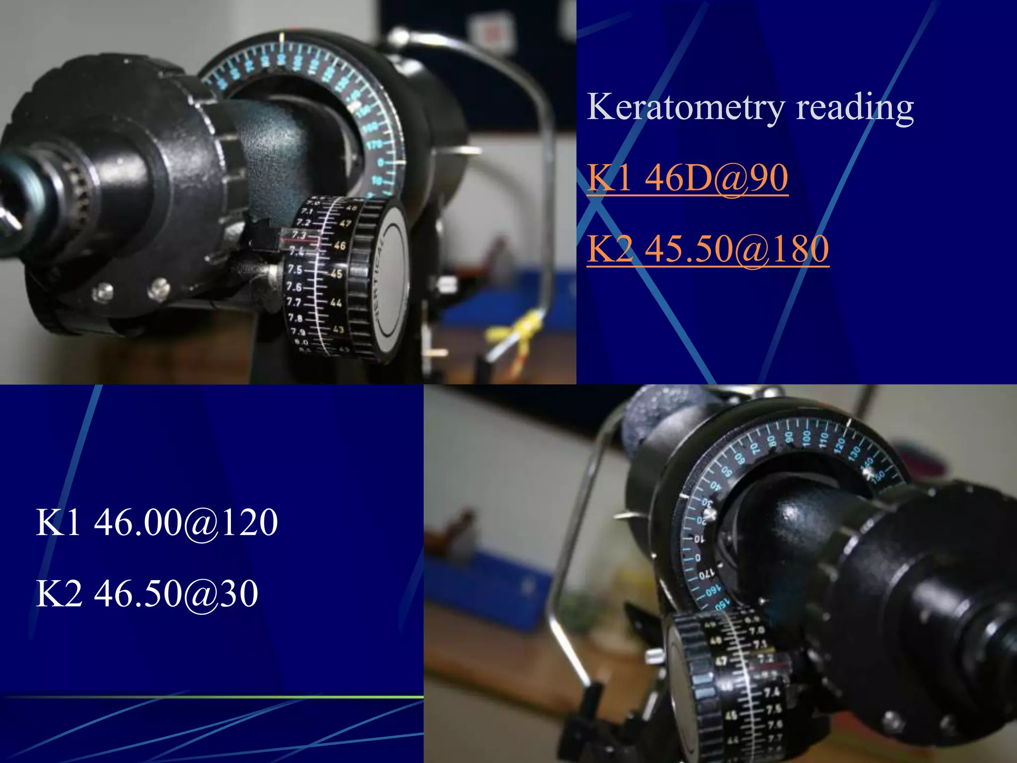 Keratometer | PPTX