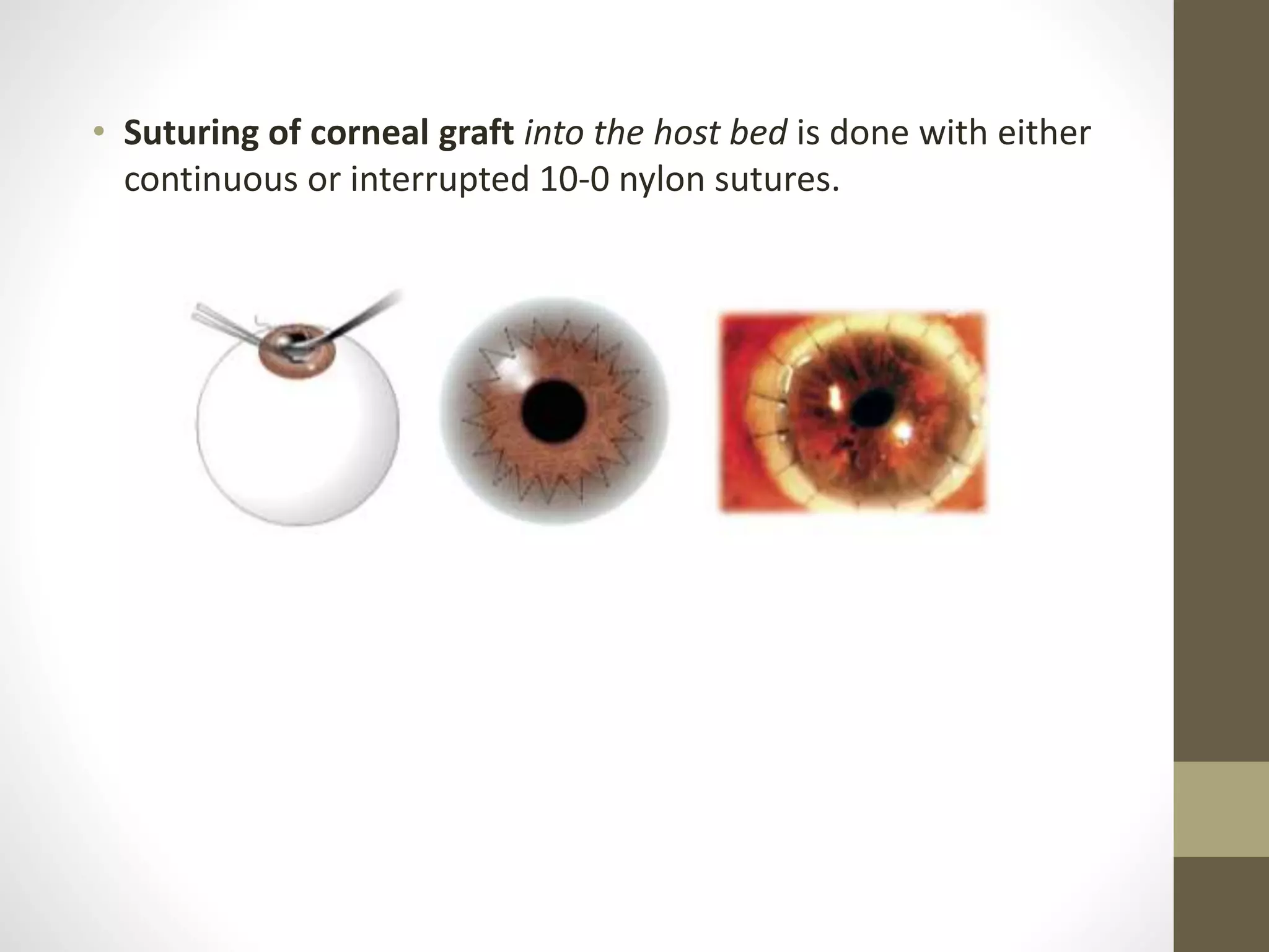 Keratoplasty | PPTX