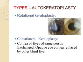 Keratoplasty , Dr M SAQUIB | PPT