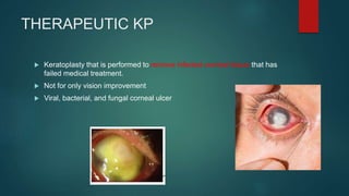 KERATOPLASTY by arthur mohan and niko.pptx