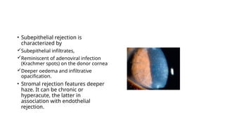 keratoplasty.corneal transplant surgery. | PPTX