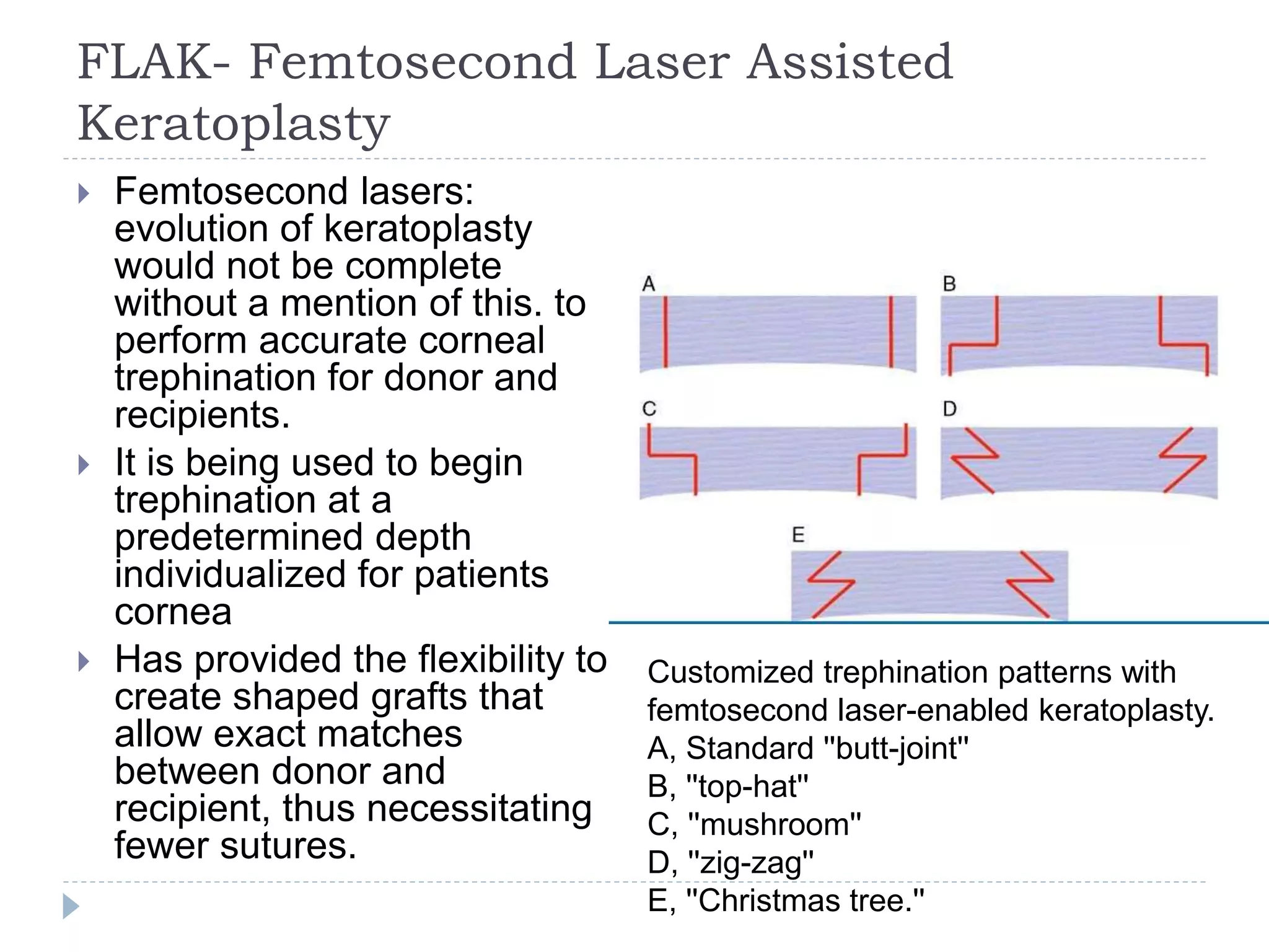 Keratoplasty overview | PPTX