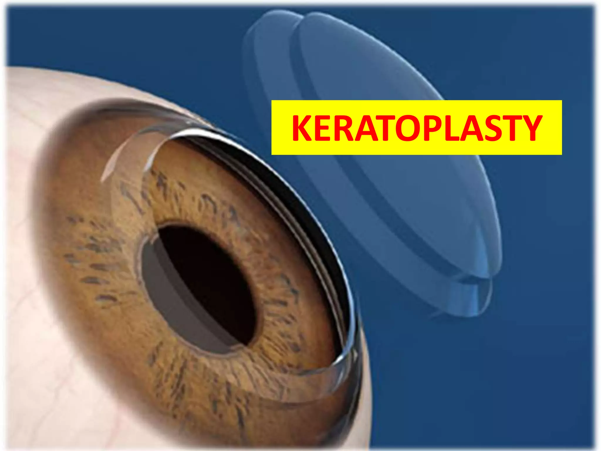 Keratoplasty patient education | PPTX