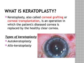 keratoplasty and eye banking ppt.pptx