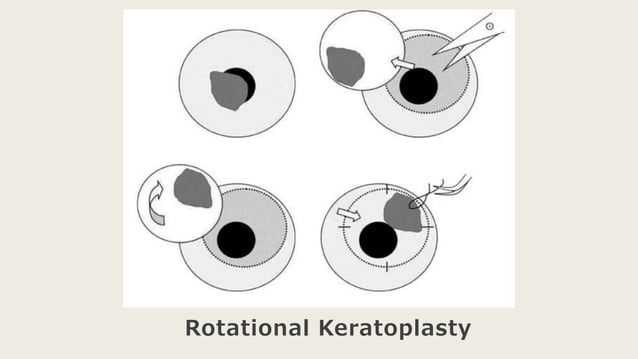 INDICATIONS OF KERATOPLASTY (Bindu K M) | PPTX
