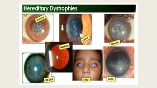 INDICATIONS OF KERATOPLASTY (Bindu K M) | PPTX