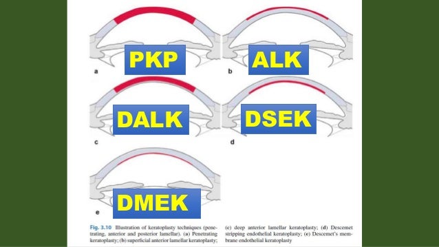 Keratoplasty update 2016