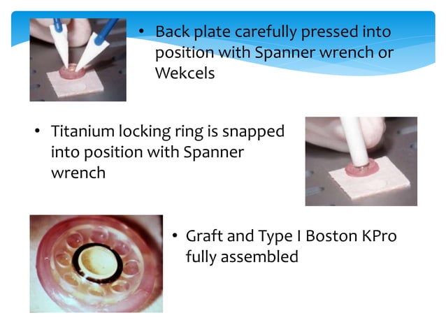 Keratoprosthesis | PPTX