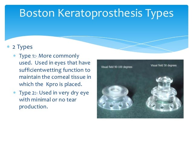 Keratoprosthesis