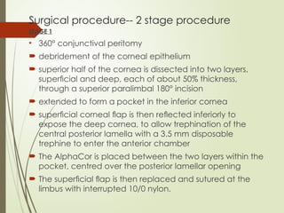 KERATOPROSTHESIS USES AND TYPESSSSSSSSSSS | PPTX