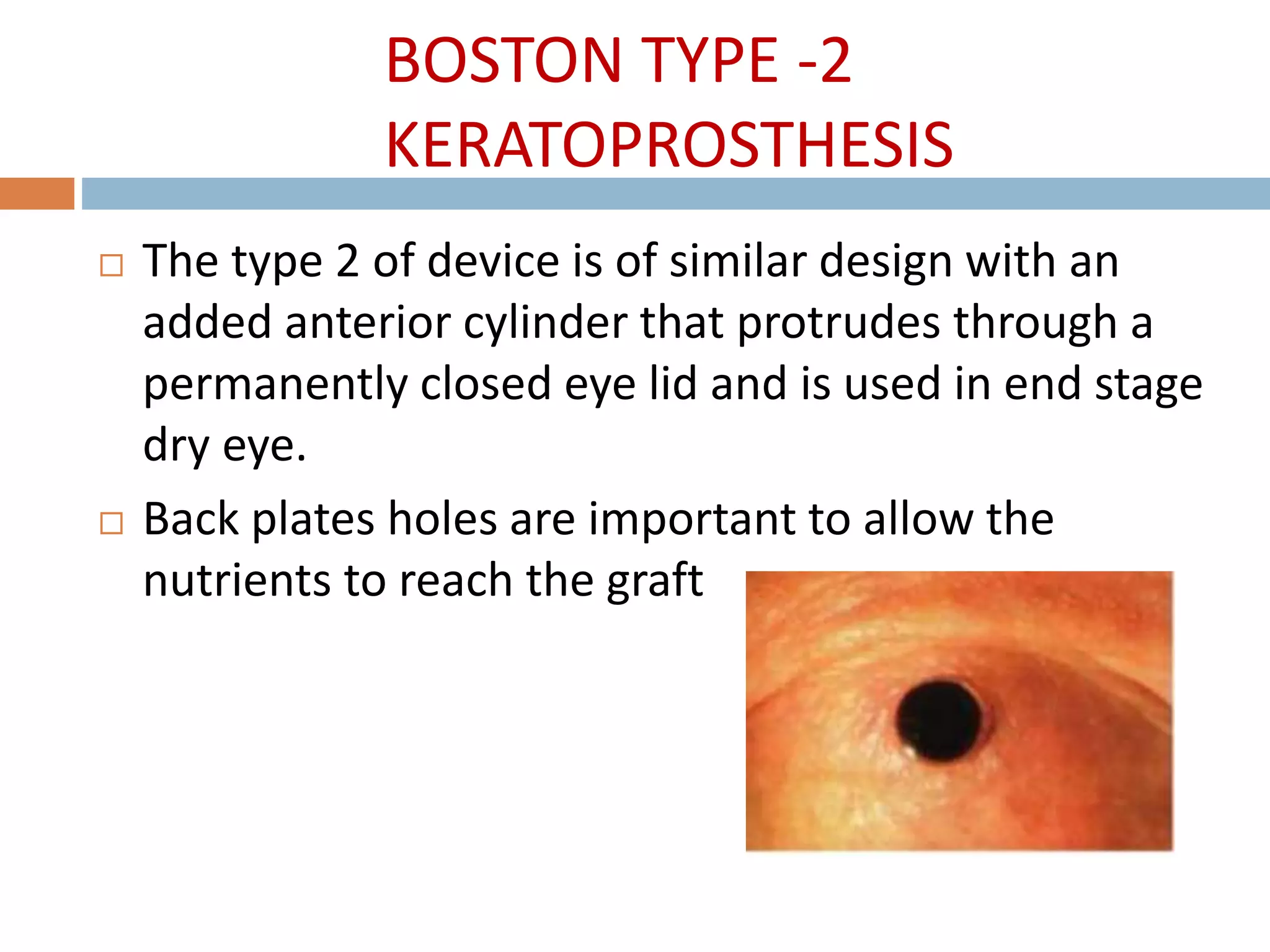 Keratoprothesis & osteoodonto keraoprosthesis | PPTX