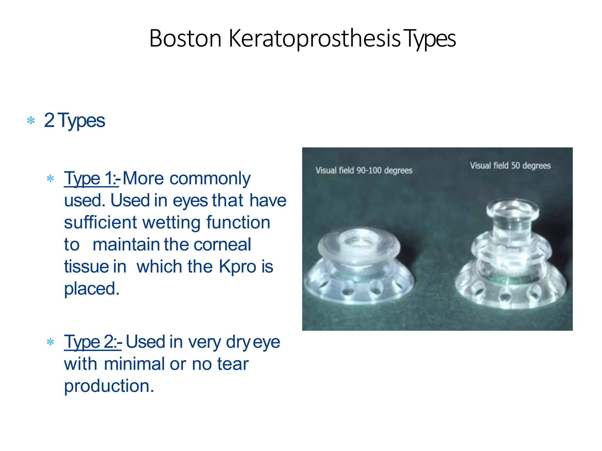 Keratoprsthesis | PPTX