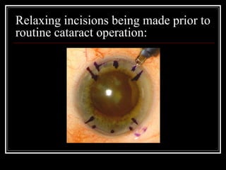 Michael Duplessie -Keratorefractive & lenticular surgery | PPT