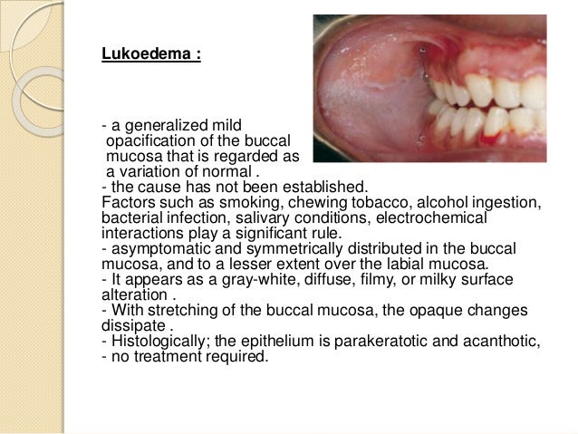Keratosis and-related-disorder-of-the-oral-mucosa
