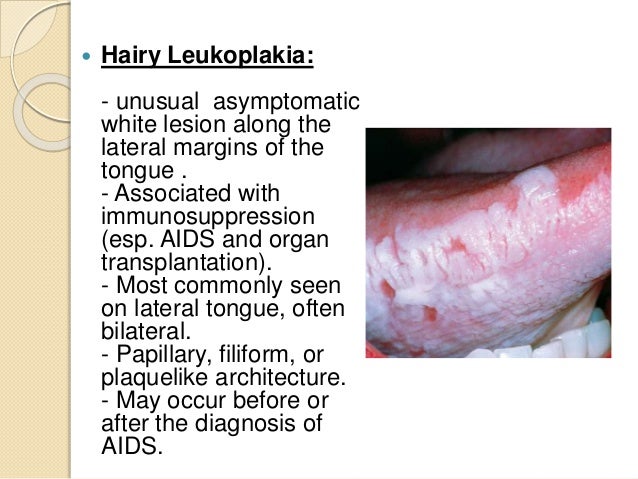 Oral Frictional Hyperkeratosis Tongue