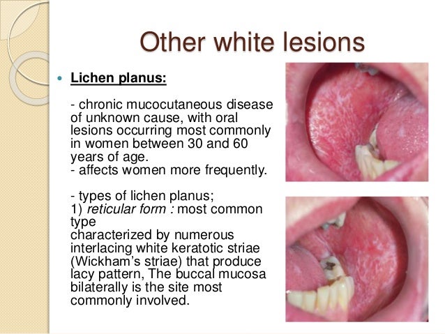 Keratosis And Related Disorder Of The Oral Mucosa