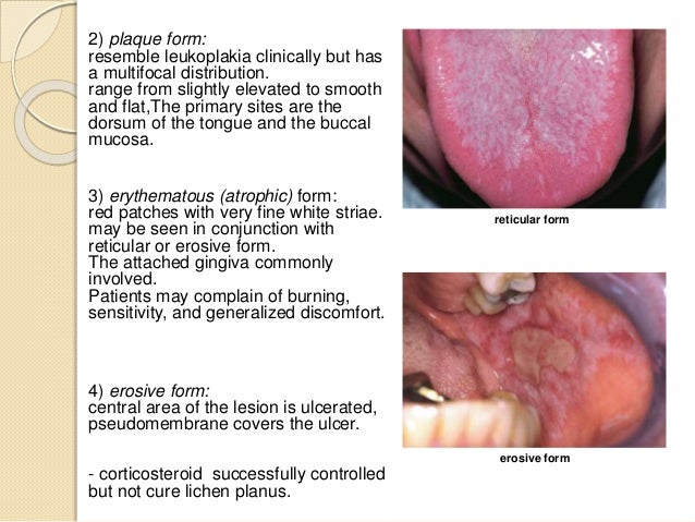 Keratosis and-related-disorder-of-the-oral-mucosa