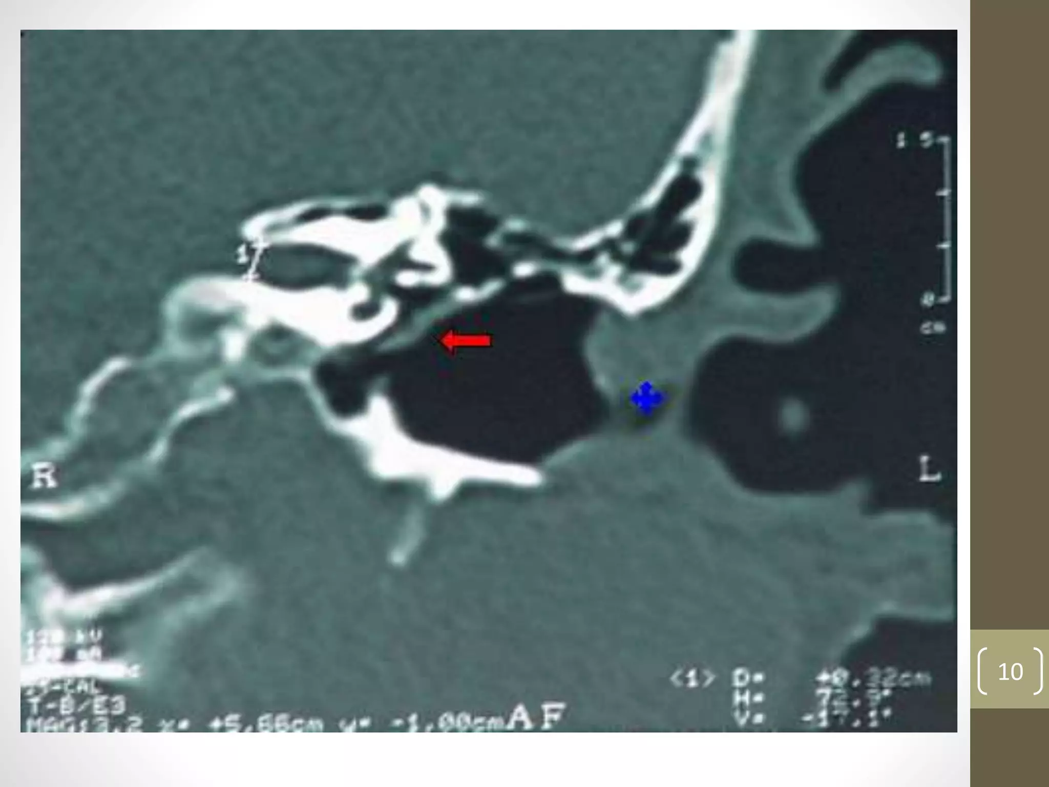 Keratosis obturans | PPTX