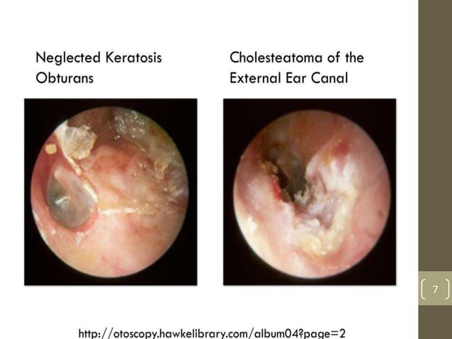 Keratosis obturans | PPTX
