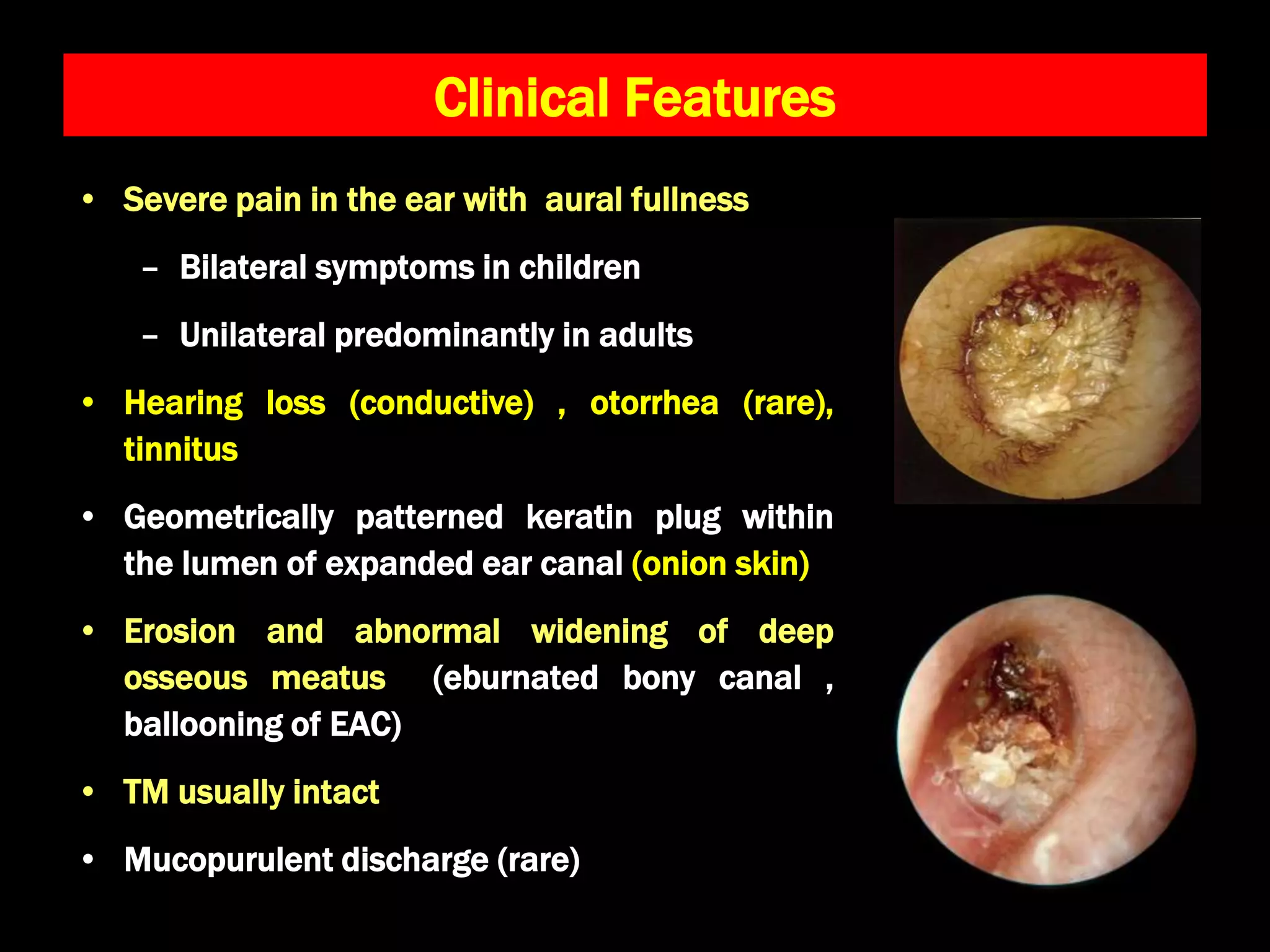 Keratosis Obturans | PPT