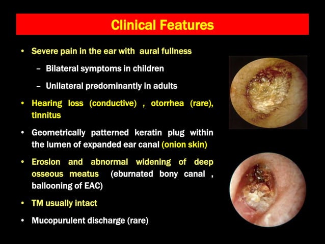 Keratosis Obturans Ppt