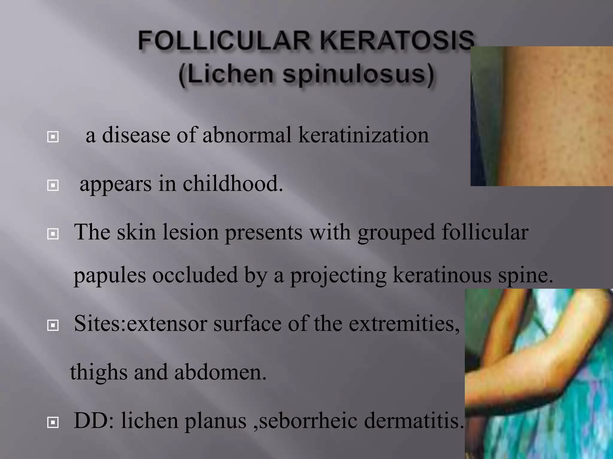 Keratosis pilaris | PPTX