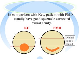 Keratotorus pellucid marginal degeneration | PPT