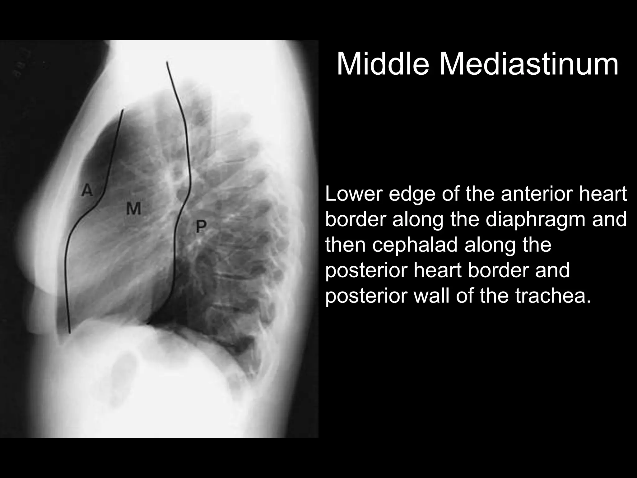 Kershaw select slides mediastinum masses | PPTX